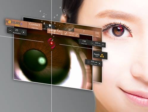 OD-OS Releases Intuitive Iridotomy Treatment with the Navilas 577s ...