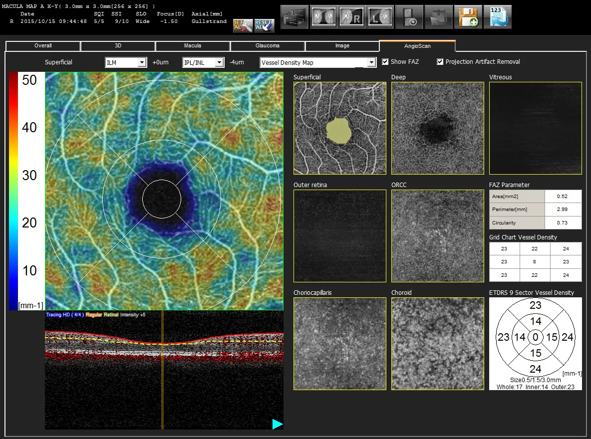 Nidek Launches Upgraded AngioScan OCT-Angiography Software - Eyewire+