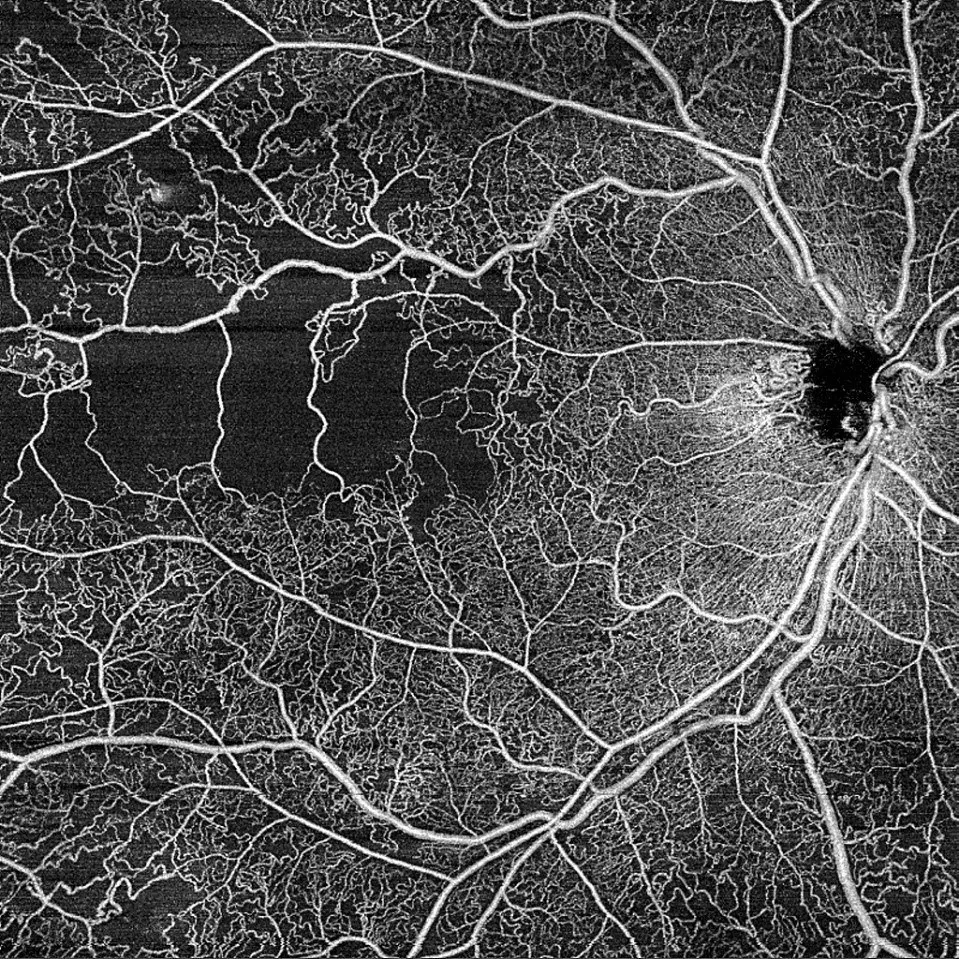 Zeiss Launches First Dual-Speed Swept-Source OCT/OCTA at ARVO - Eyewire+